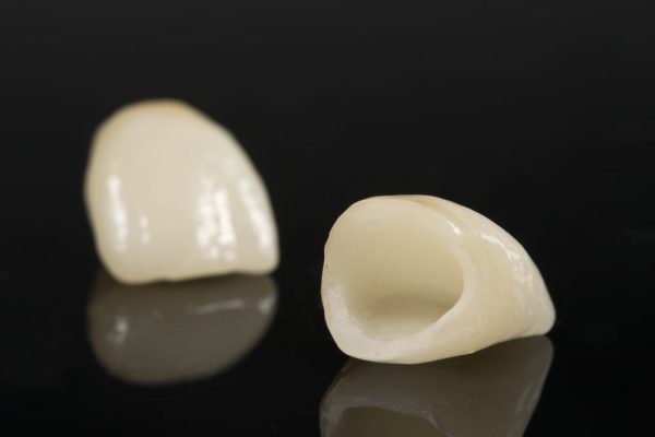 Emax Crowns in Turkey: Cost of the Treatment