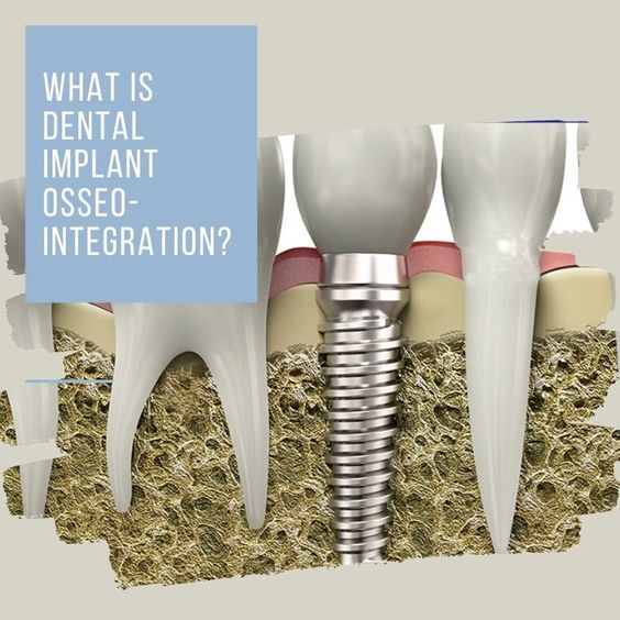 All-on-4 Dental Implantation in Antalya, Turkey