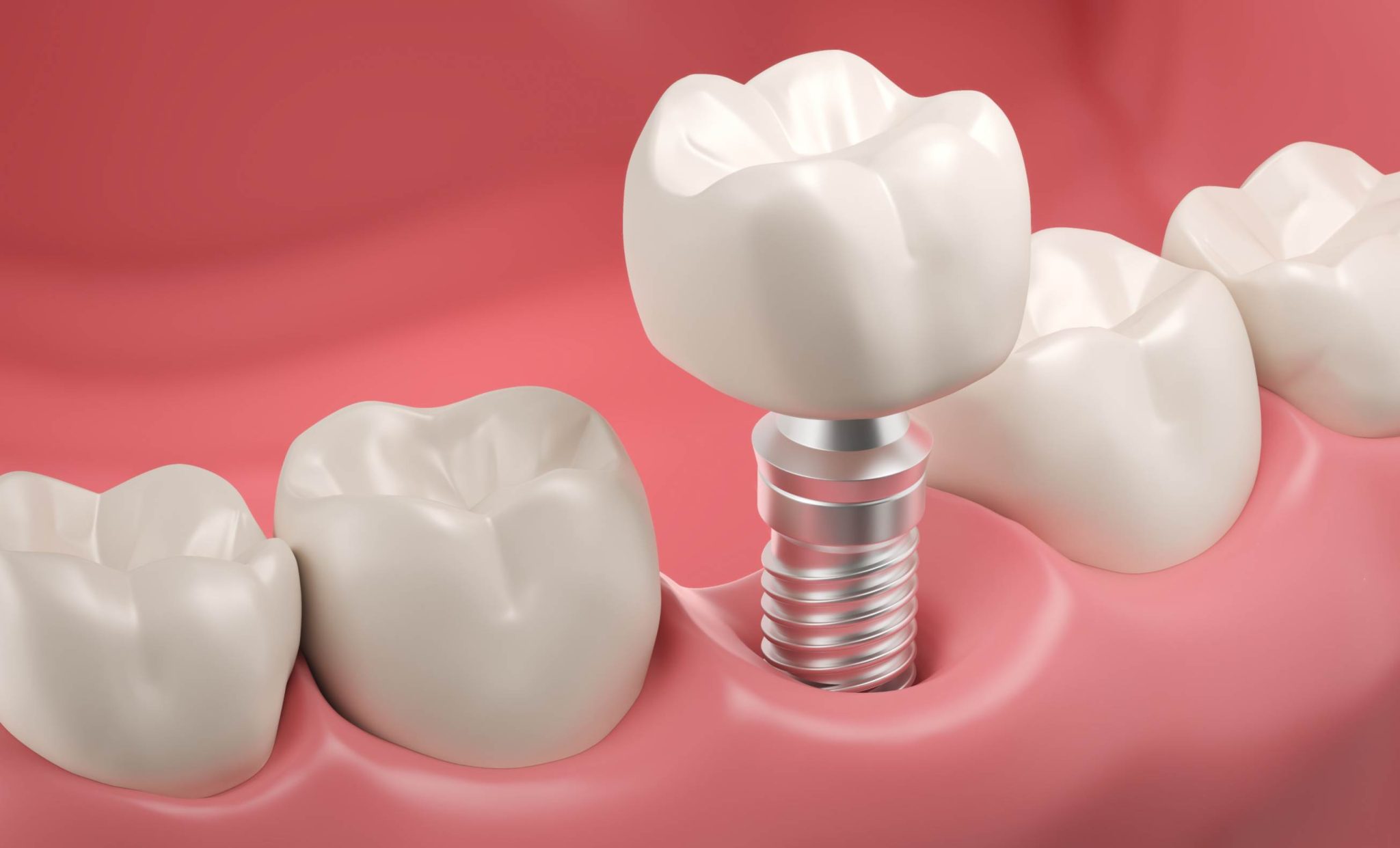 Emax Crowns in Turkey: Cost of the Treatment