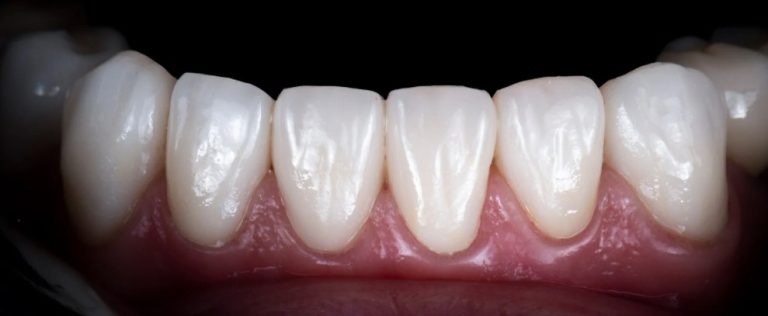 Emax Crowns in Turkey: Cost and Benefits | VK Smile Studio
