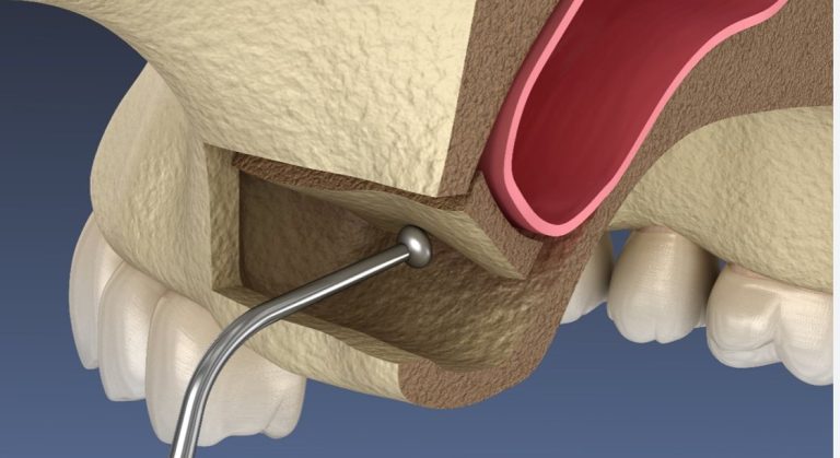 Sinus Lifting Procedure in Turkey: Cost, Types and Benefits