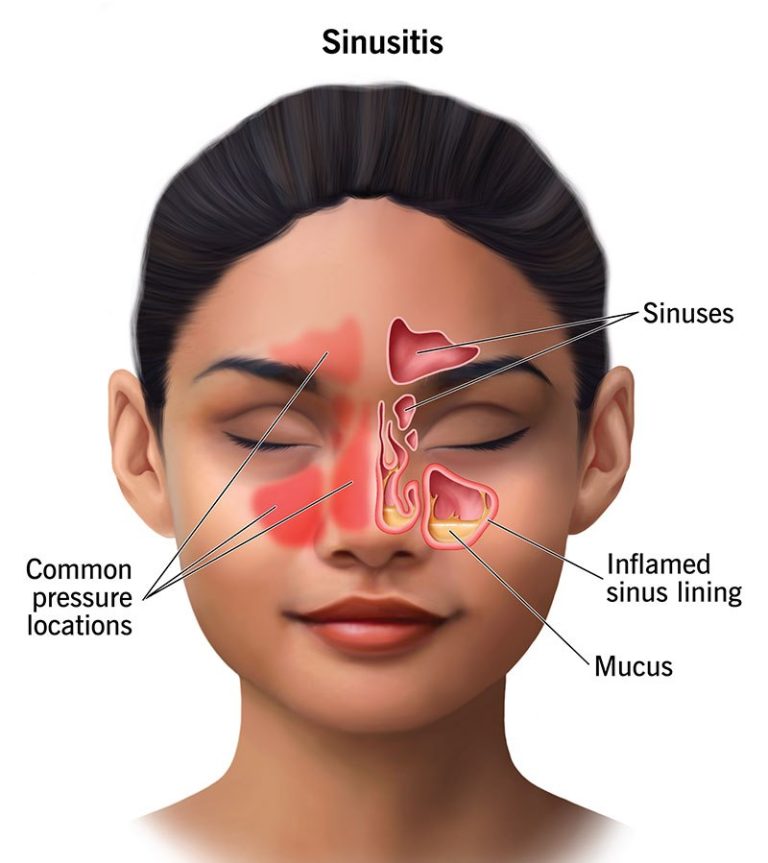 Sinus Lifting Procedure in Turkey: Cost, Types and Benefits